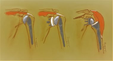 PRÓTESIS DE HOMBRO - Dr. Ángel Torres