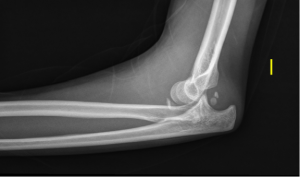 LESIONES TRAUMÁTICAS DE CODO - Dr. Ángel Torres