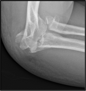 LESIONES TRAUMÁTICAS DE CODO - Dr. Ángel Torres