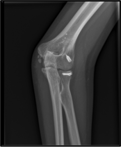 LESIONES TRAUMÁTICAS DE CODO - Dr. Ángel Torres