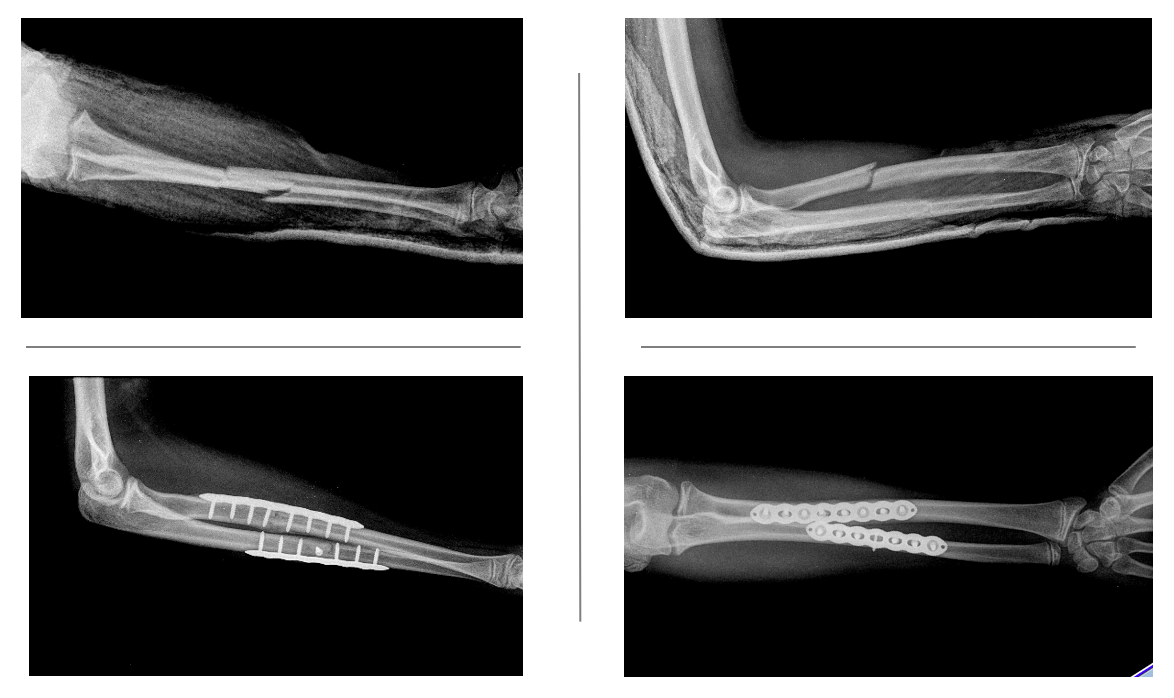 FRACTURAS - Dr. Ángel Torres