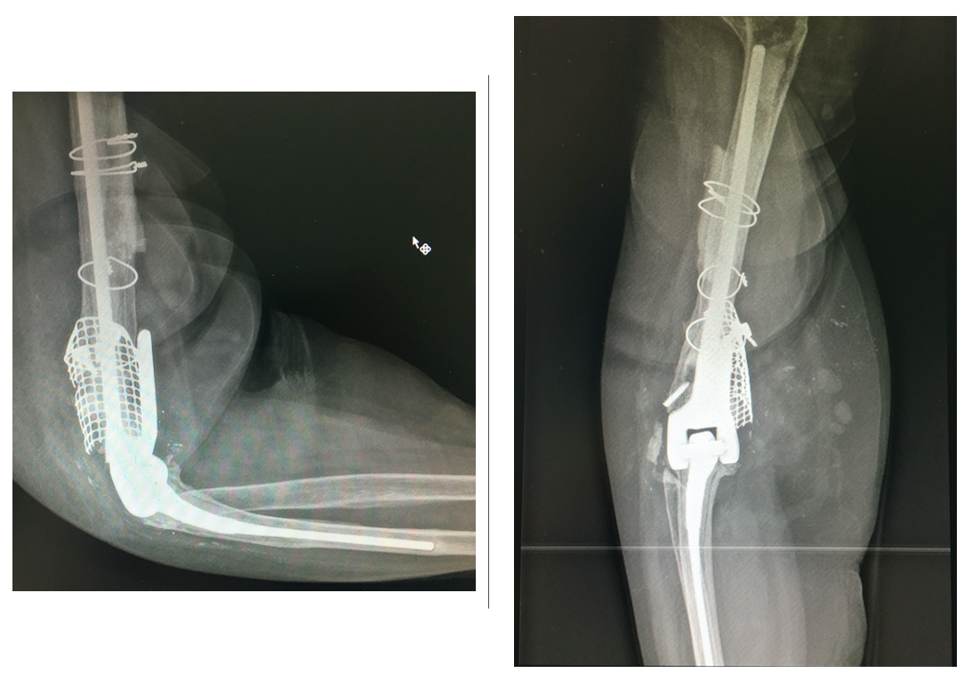 CIRUGÍA PROTÉSICA DE CODO - Dr. Ángel Torres